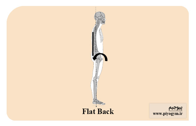 ناهنجاری های شایع وضعیت بدن و بهترین وضعیت بدنی | پیوجیم