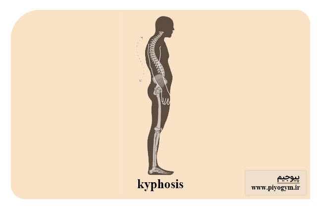 ناهنجاری های شایع وضعیت بدن و بهترین وضعیت بدنی | پیوجیم